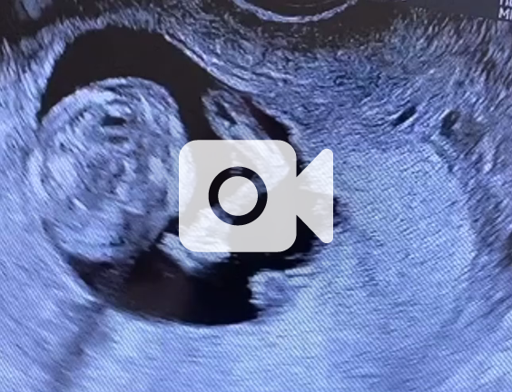 ＊妊娠11w3d | hyeona-ri5のブログ